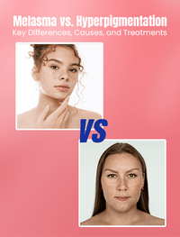 Melasma vs. Hyperpigmentation: Key Differences, Causes, and Treatments